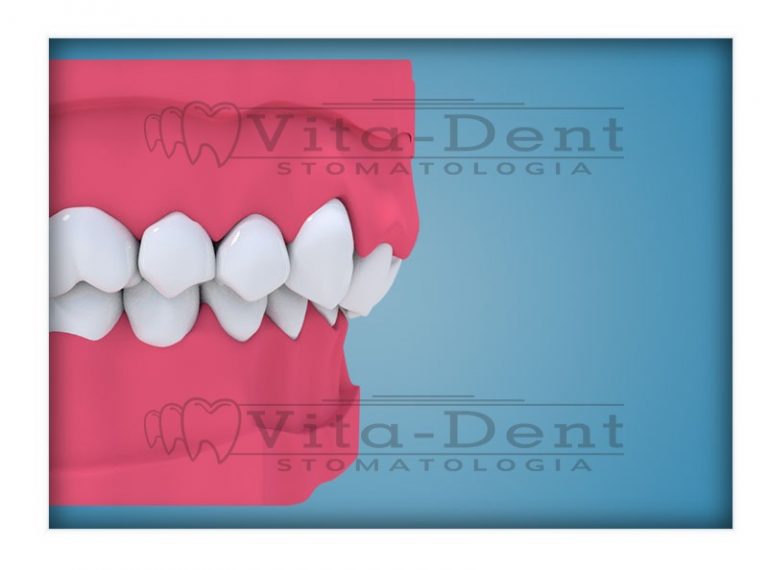 Tiefer Biss - Vita-Dent Stomatologia